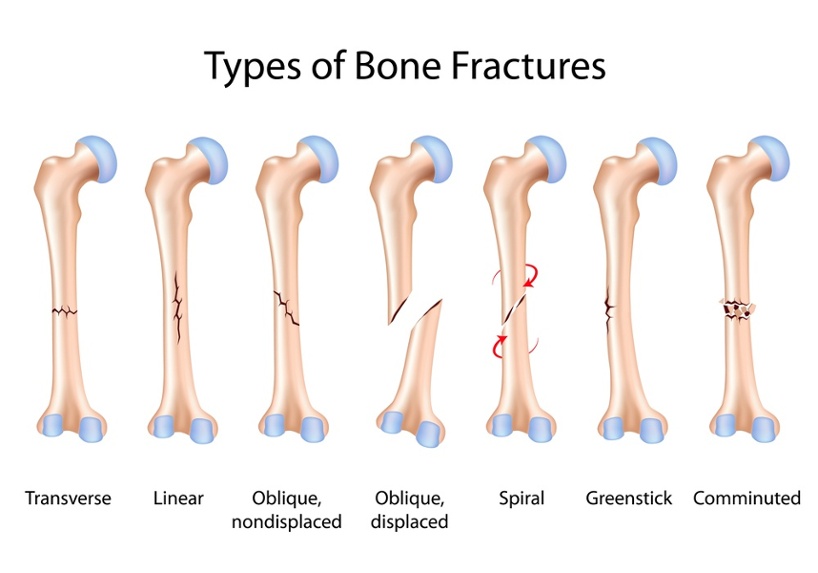 Fractures From Injury To Return 411 The Sports Medicine Broadcast